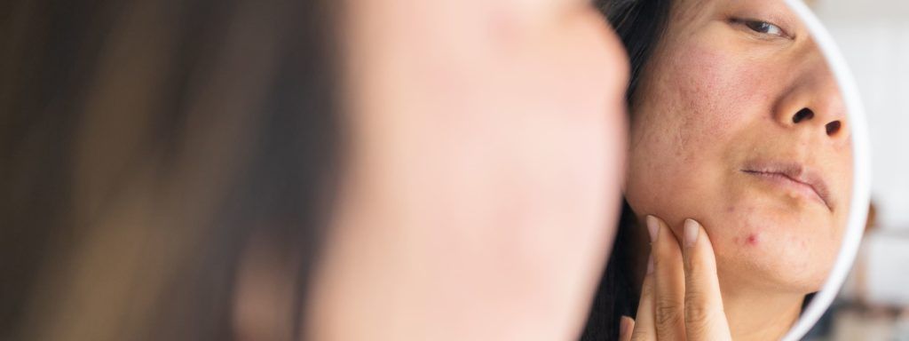 Guide for Preventing & Treating Acne Scars | Forest Essentials