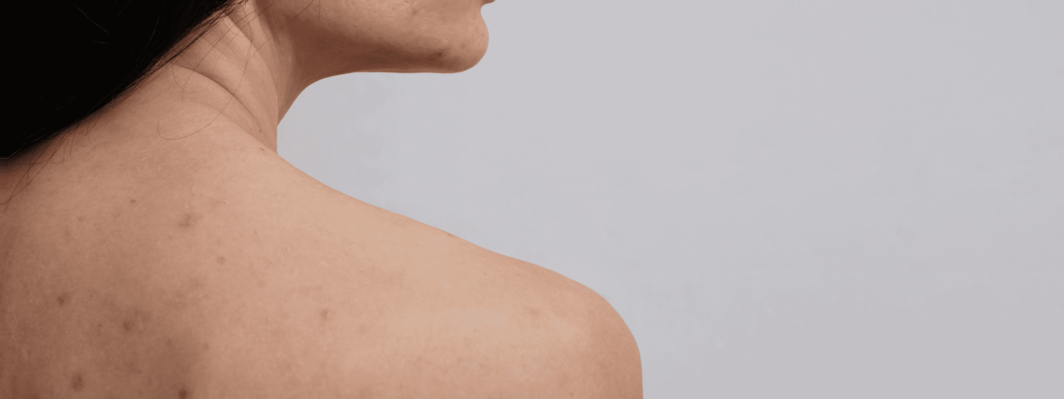 Natural Homemade Remedies For Back Acne | Forest Essentials